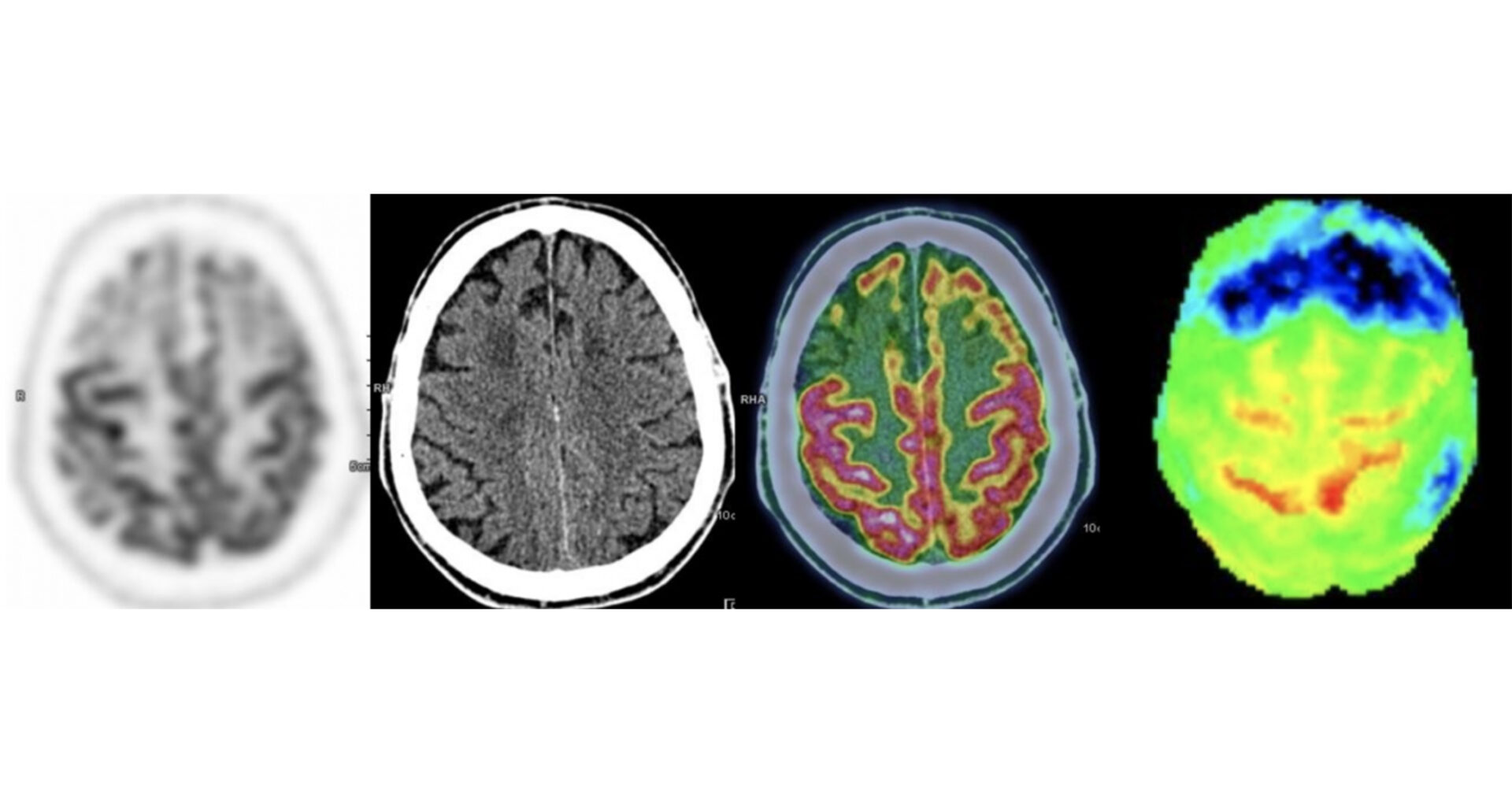 Imagerie thoracique (TEP FDG) - CEI