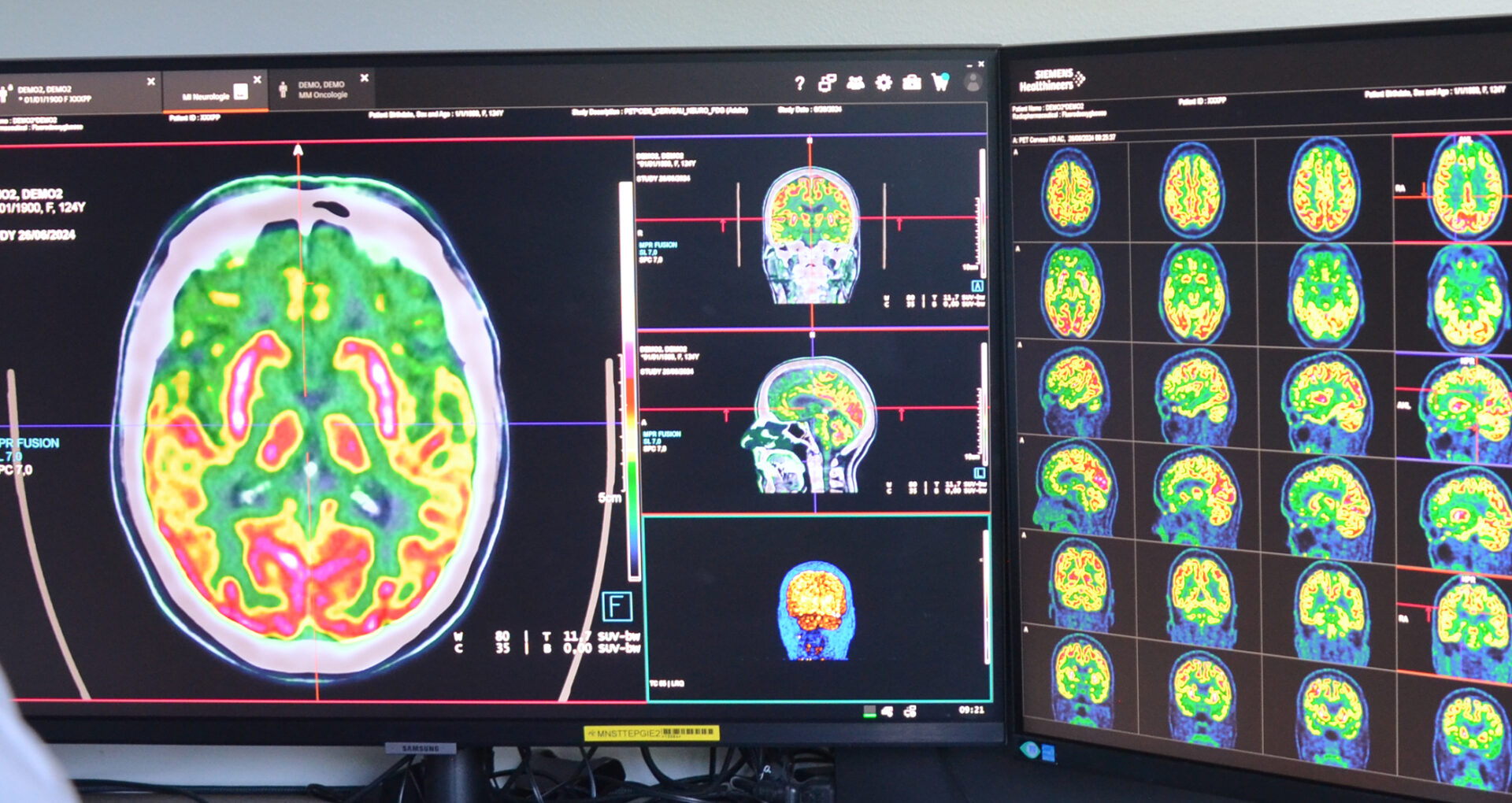 Scintigraphie cérébrale - CEI