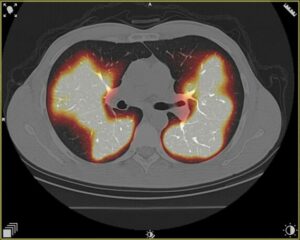 Scinti-Scanner pulmonaire - CEI